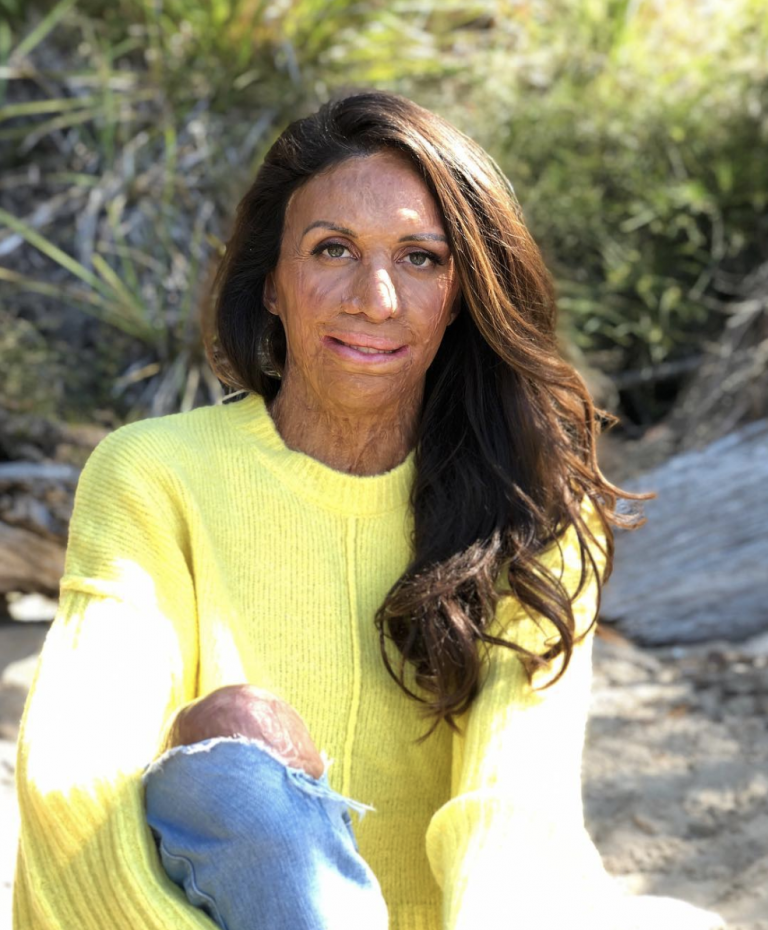 Sevgilisinin Desteğiyle Hayata Yeniden Tutunan Mucize Kadın: Turia Pitt
