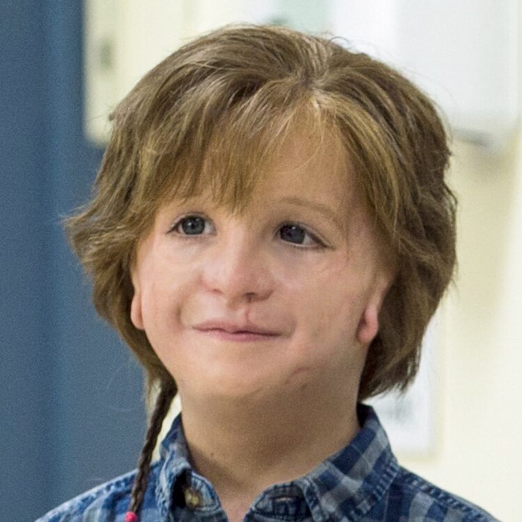 Dünyada Yalnızca 90'a Yakın Kişide Görülen Nager Sendromu Nedir?