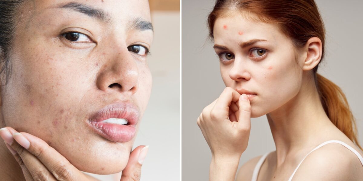 Sebum Nedir? Cildin Sebum Dengesi Hakkında Bilmeniz Gereken 5 Şey