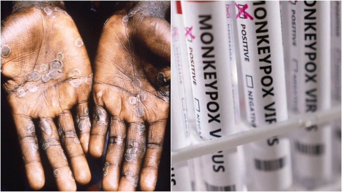 Maymun Çiçeği Virüsü: Endişelenmeli Miyiz, Yeni Bir Pandemi İhtimali ...