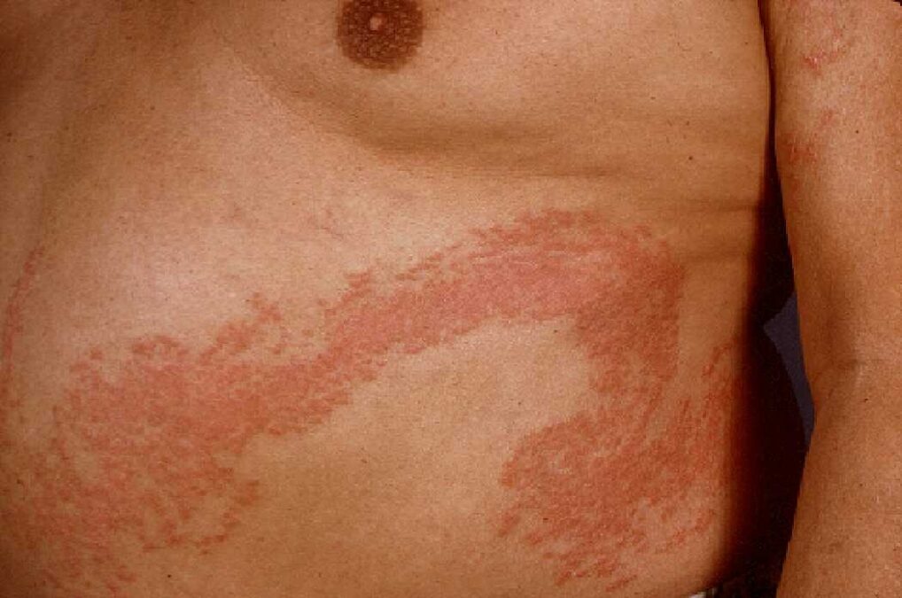 Blaschko Çizgileri: İnsan Vücudunun Çıplak Gözle Görülemeyen Gizemli ...