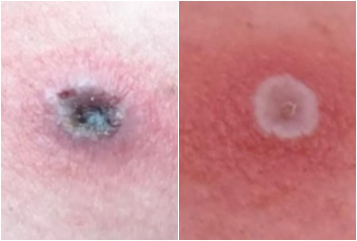 İlk Kez Bir Ölüme Sebep Oldu! 2015 Yılında Keşfedilen Alaskapox Virüsü ...