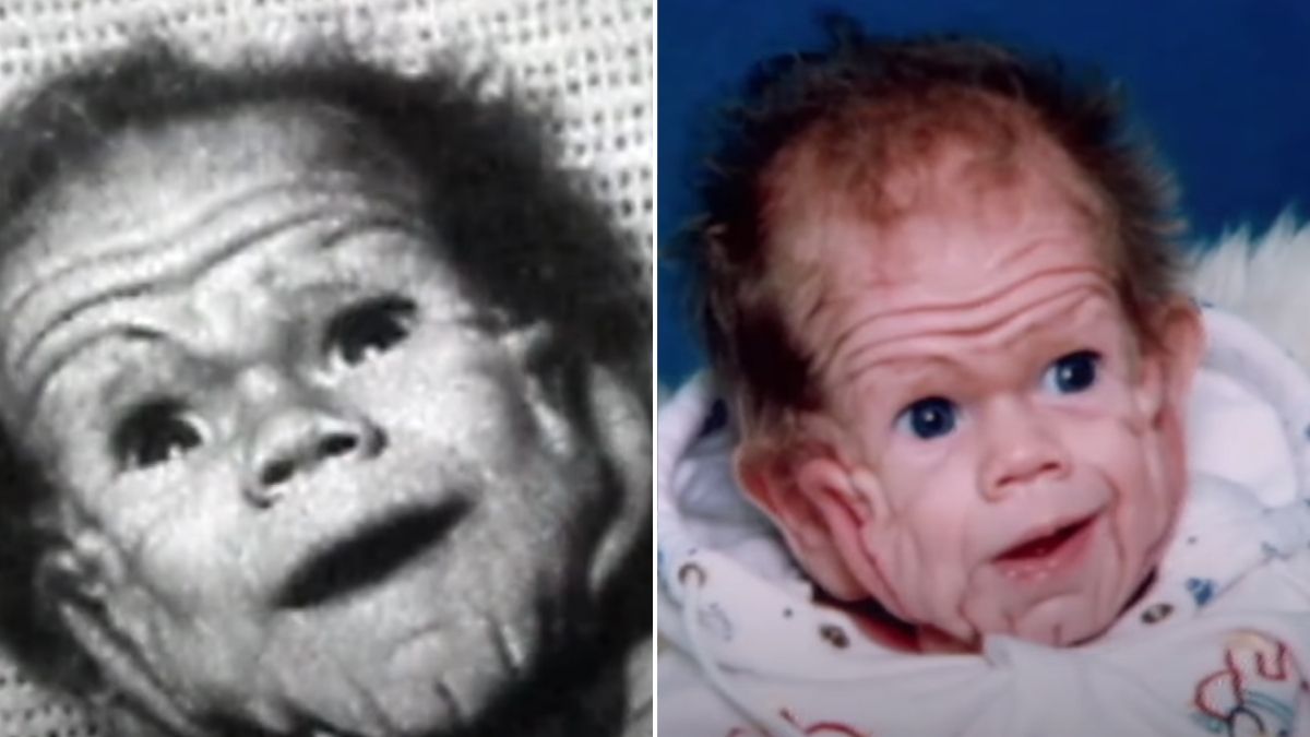 Tomm Tennent: Yaşlı Bir İnsanın Cildiyle Doğan Bebek | ListeList.com