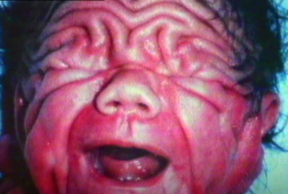 Tomm Tennent: Yaşlı Bir İnsanın Cildiyle Doğan Bebek | ListeList.com